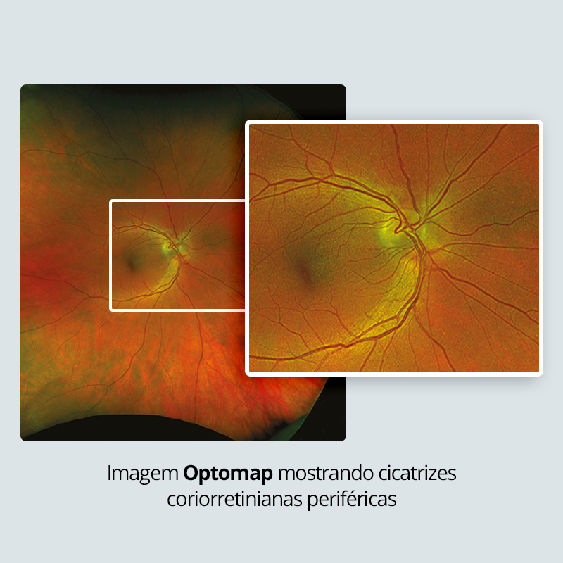 Apramed - RETINÓGRAFO OPTOS CALIFORNIA